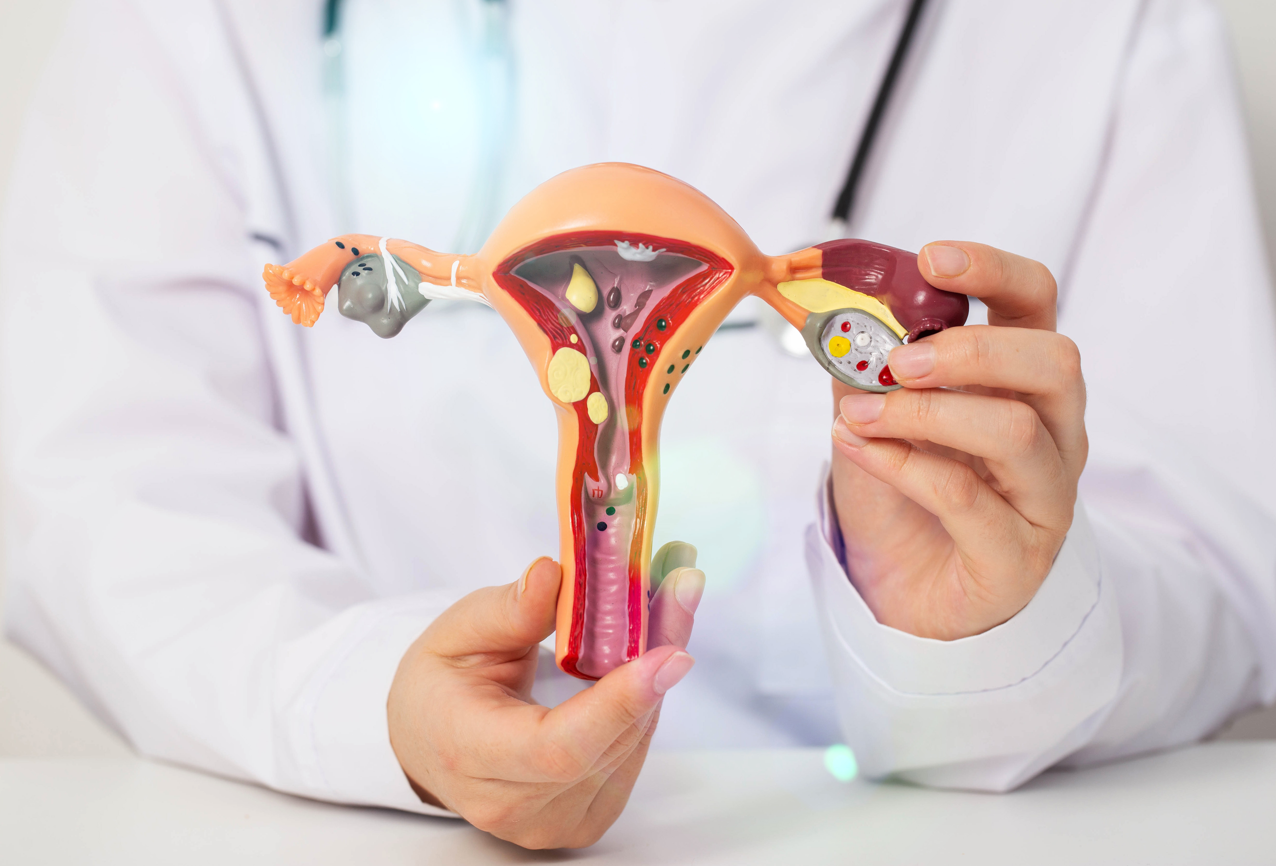 When Ovarian Cyst Removal Becomes the Best Option